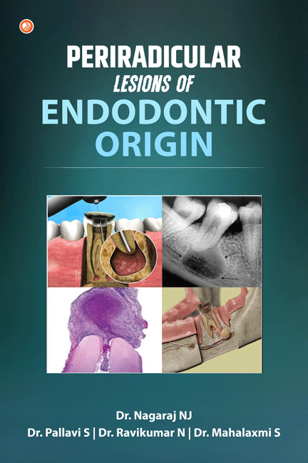 Periradicular lesions of Endodontic origin | Wissen Bookstore
